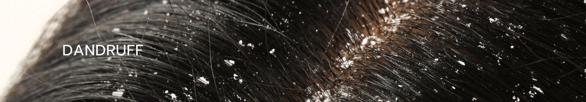 Dandruff – SKINSYRUP